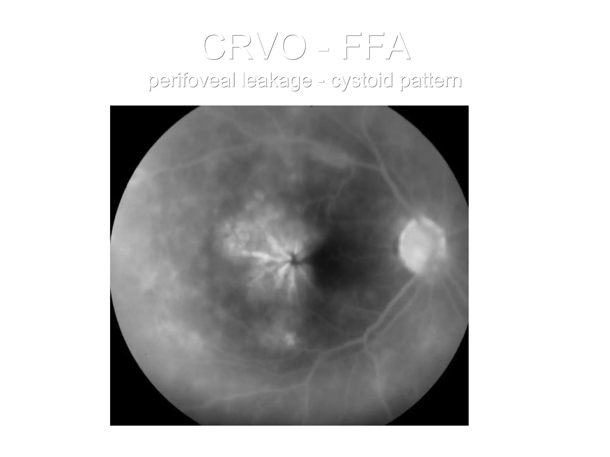 Retinal venous occlusive disease | PPT