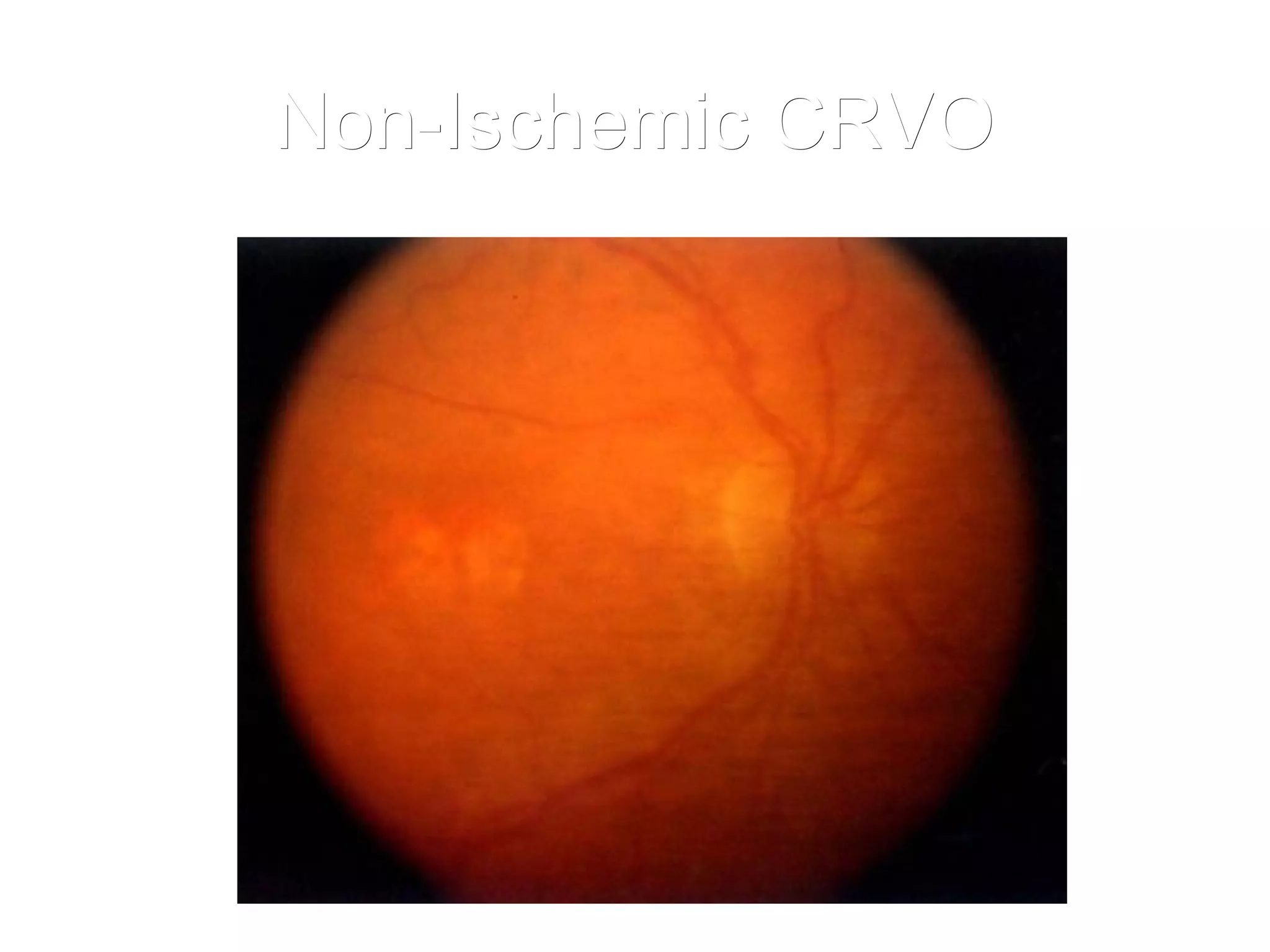 Retinal venous occlusive disease | PPT