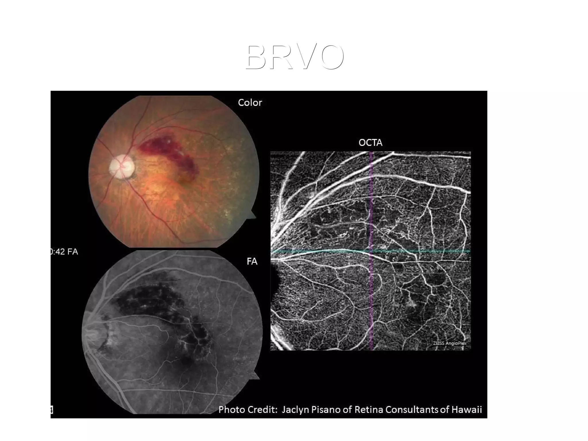 Retinal venous occlusive disease | PPT