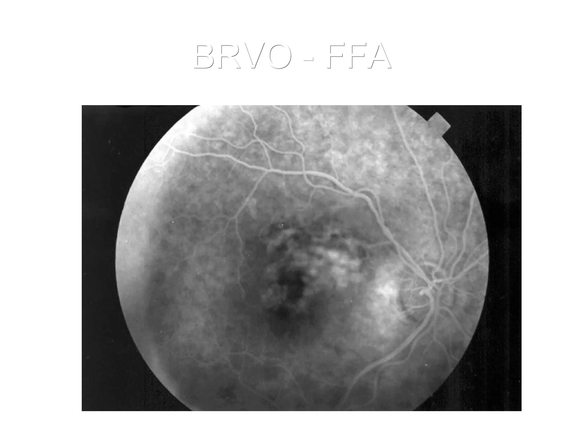 Retinal venous occlusive disease | PPT