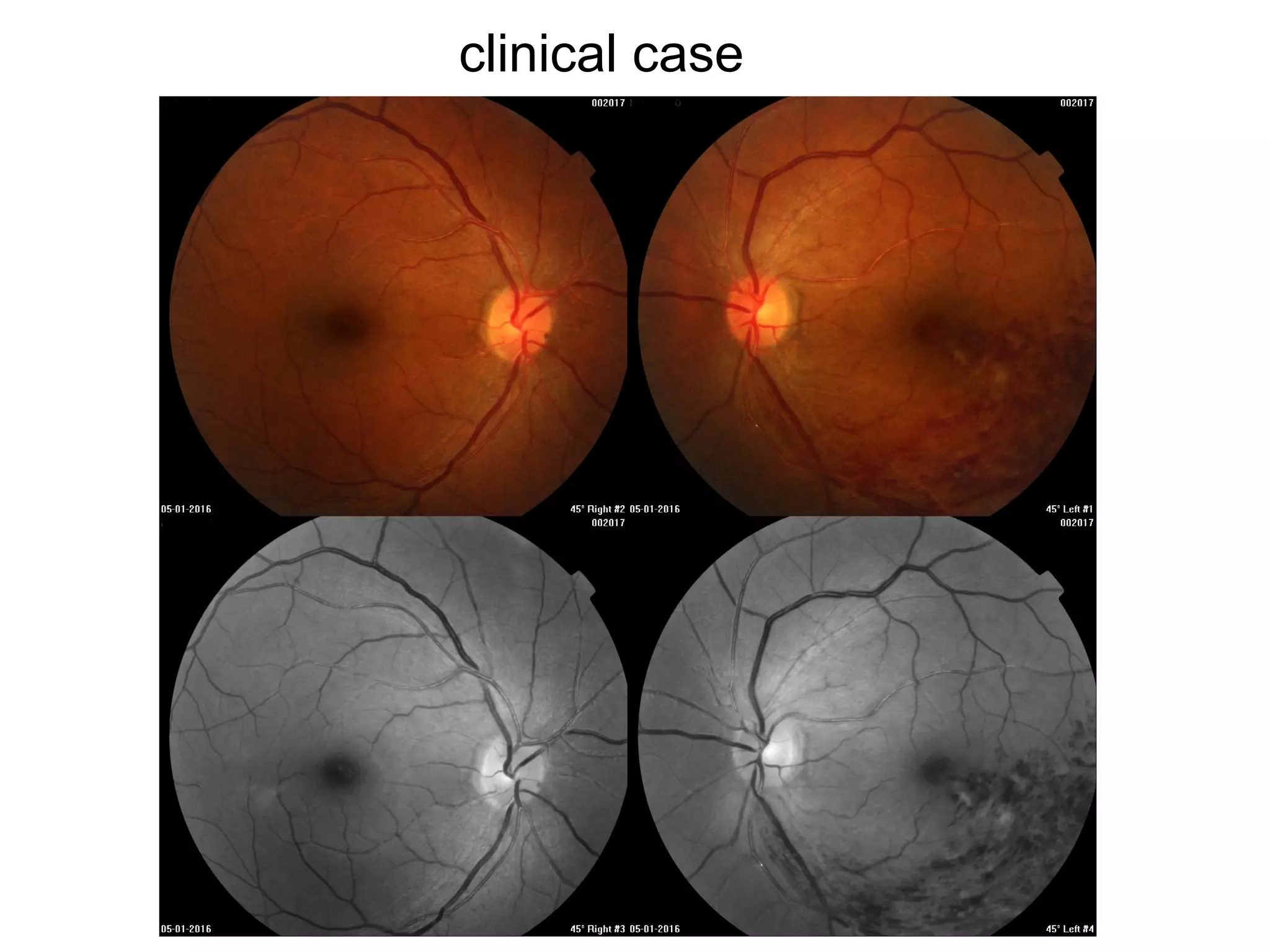 Retinal venous occlusive disease | PPT