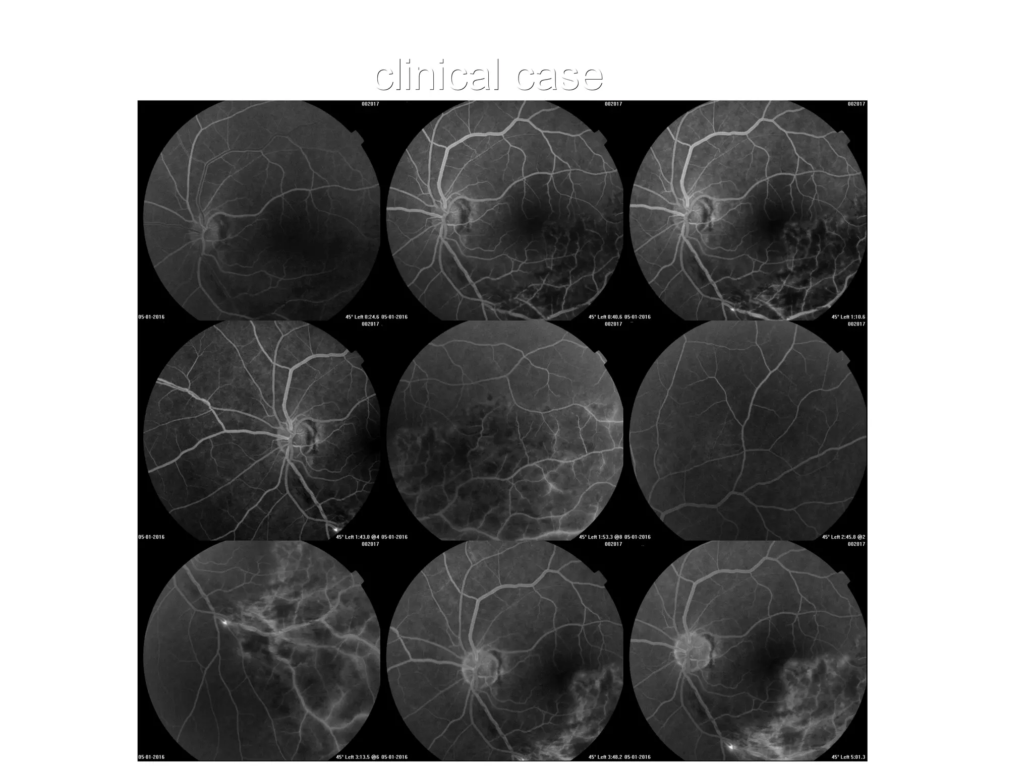 Retinal venous occlusive disease | PPT