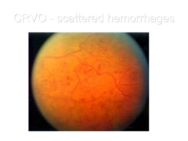 Retinal venous occlusive disease | PPT | Eye and Vision Conditions ...
