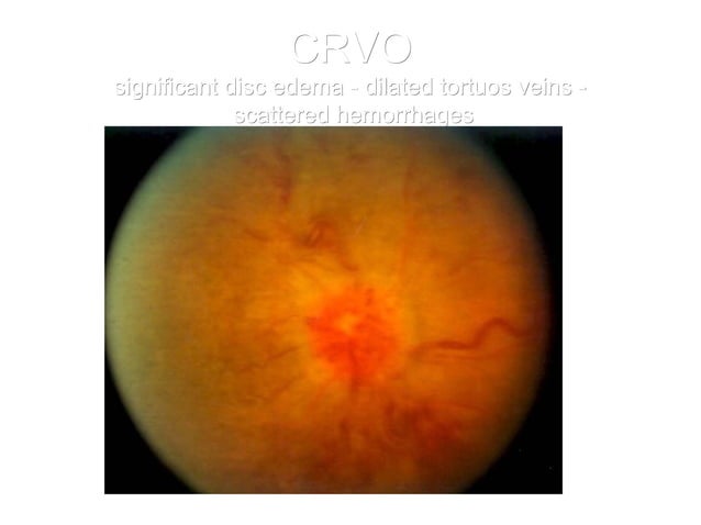 Retinal venous occlusive disease | PPT | Eye and Vision Conditions ...