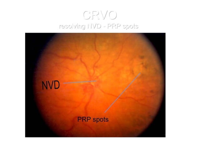 Retinal venous occlusive disease | PPT | Eye and Vision Conditions ...