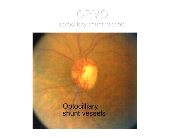 Retinal venous occlusive disease | PPT | Eye and Vision Conditions ...