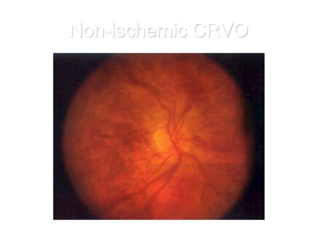 Retinal venous occlusive disease | PPT | Eye and Vision Conditions ...