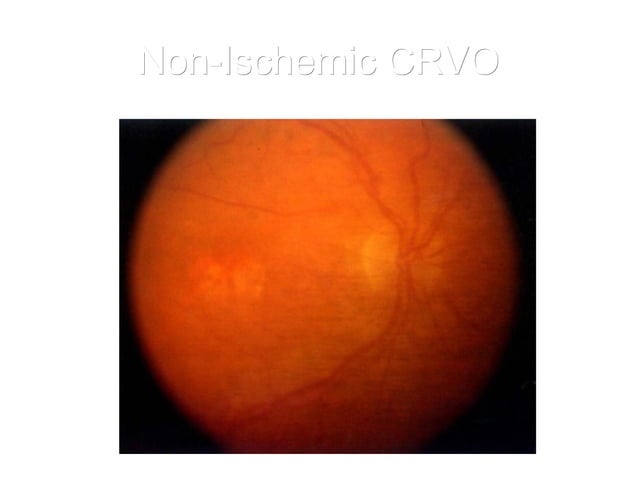 Retinal venous occlusive disease | PPT | Eye and Vision Conditions ...