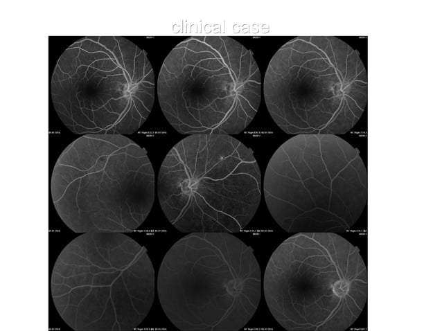 Retinal venous occlusive disease | PPT | Eye and Vision Conditions ...