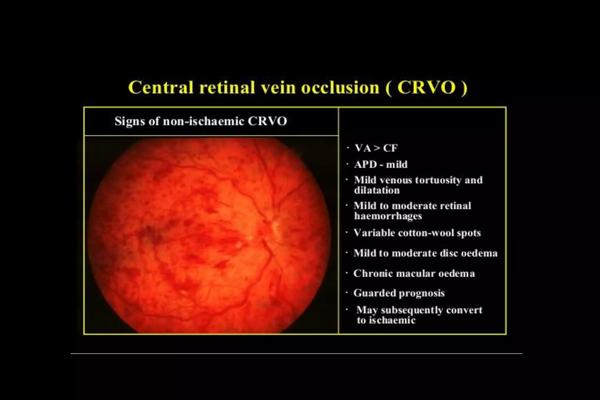 Retinal Vein occlusion,Dr Saquib | PPT
