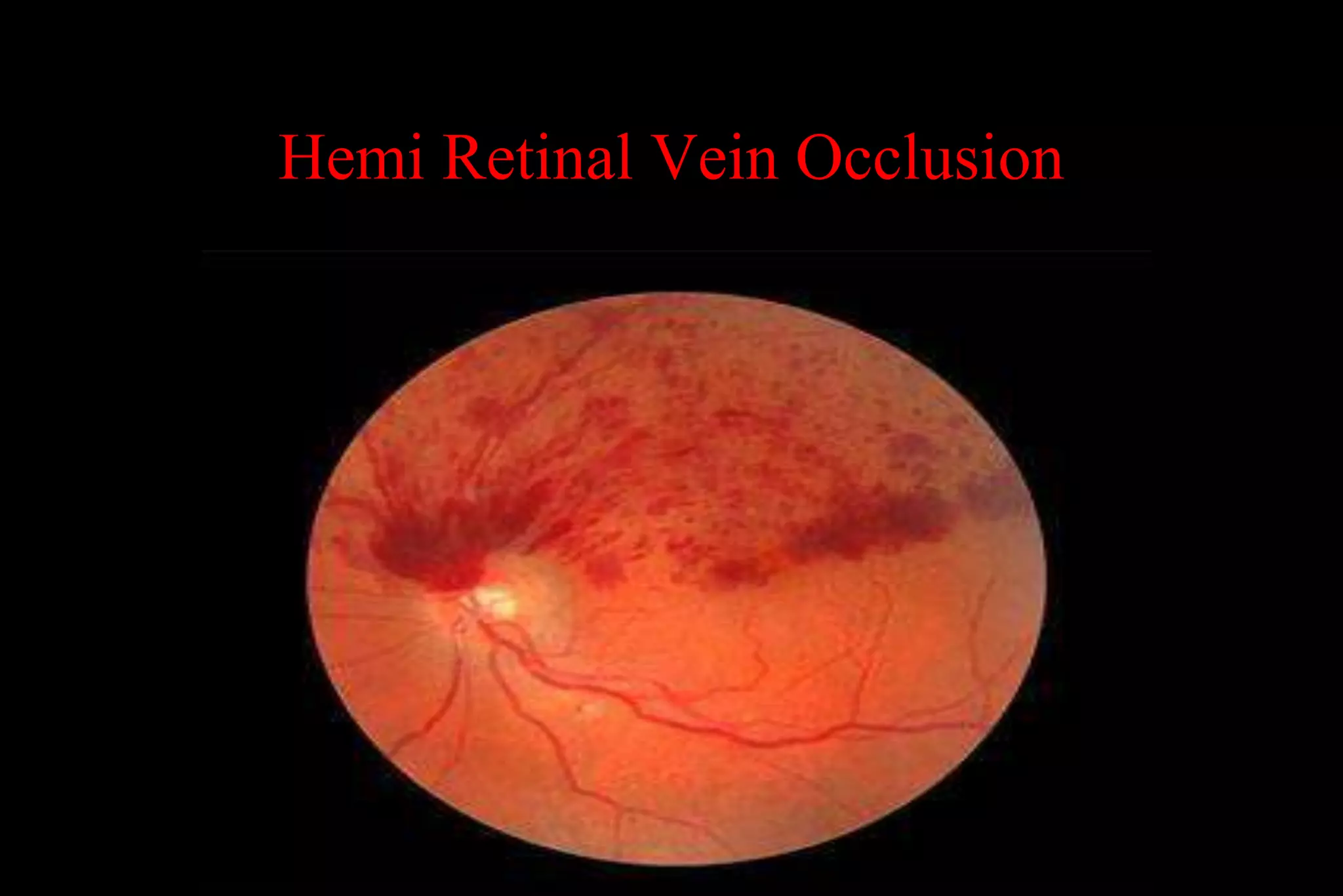 Retinal Vein occlusion,Dr Saquib | PPT
