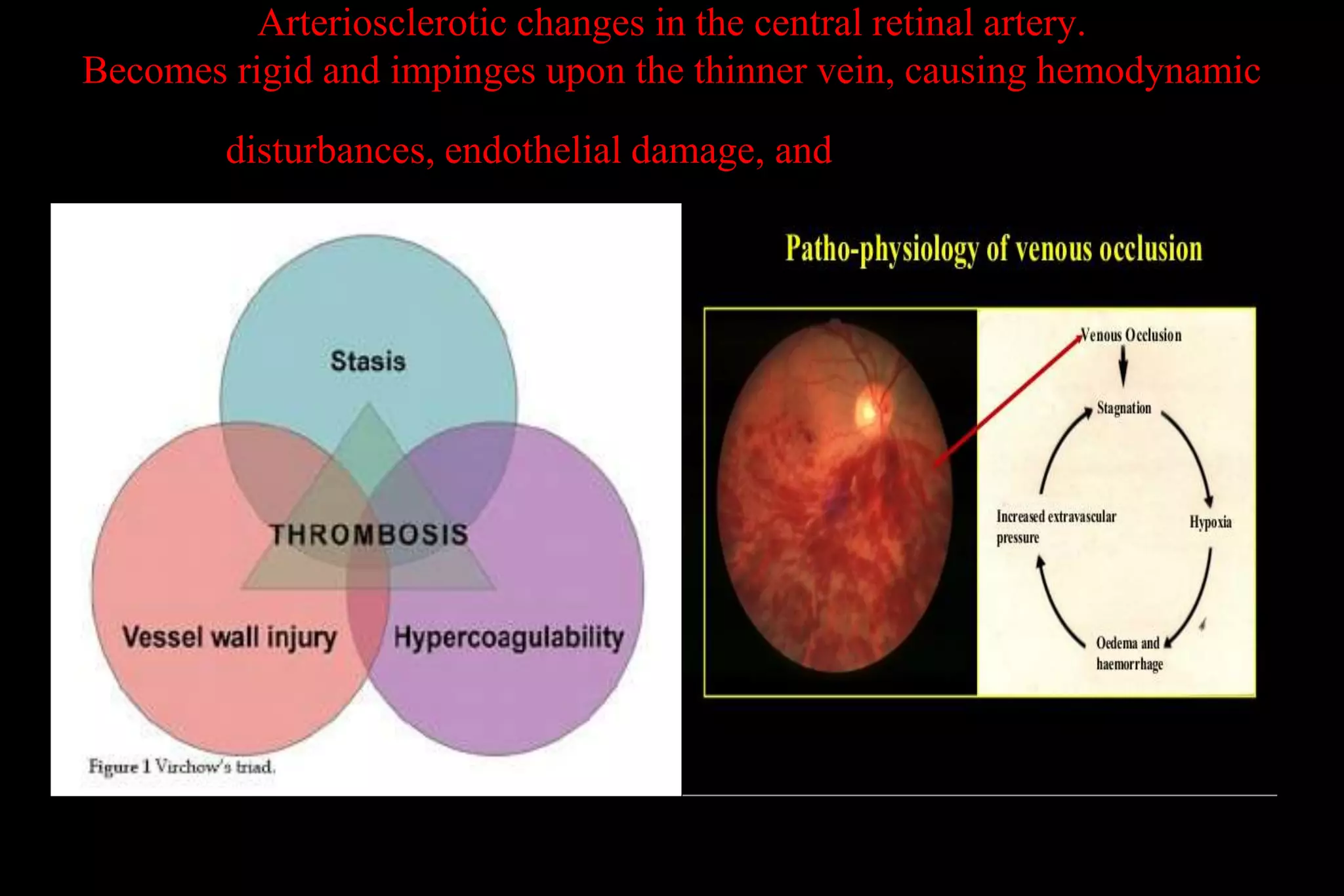 Retinal Vein occlusion,Dr Saquib | PPT