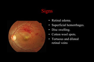 Retinal Vein occlusion,Dr Saquib | PPT