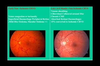 Retinal Vein occlusion,Dr Saquib | PPT