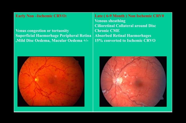 Retinal Vein occlusion,Dr Saquib | PPT | Eye and Vision Conditions ...