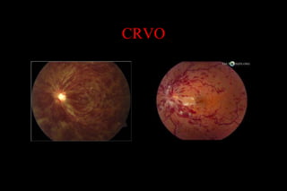 Retinal Vein occlusion,Dr Saquib | PPT