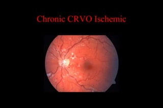 Retinal Vein occlusion,Dr Saquib | PPT