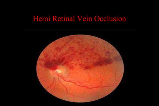Retinal Vein occlusion,Dr Saquib | PPT | Eye and Vision Conditions ...