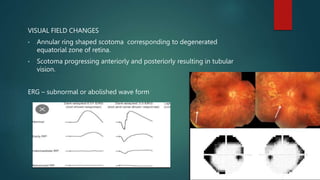 RETINA-retinal detatchment powerpoint presentation | PPTX | Eye and ...