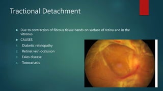 RETINA-retinal detatchment powerpoint presentation | PPTX