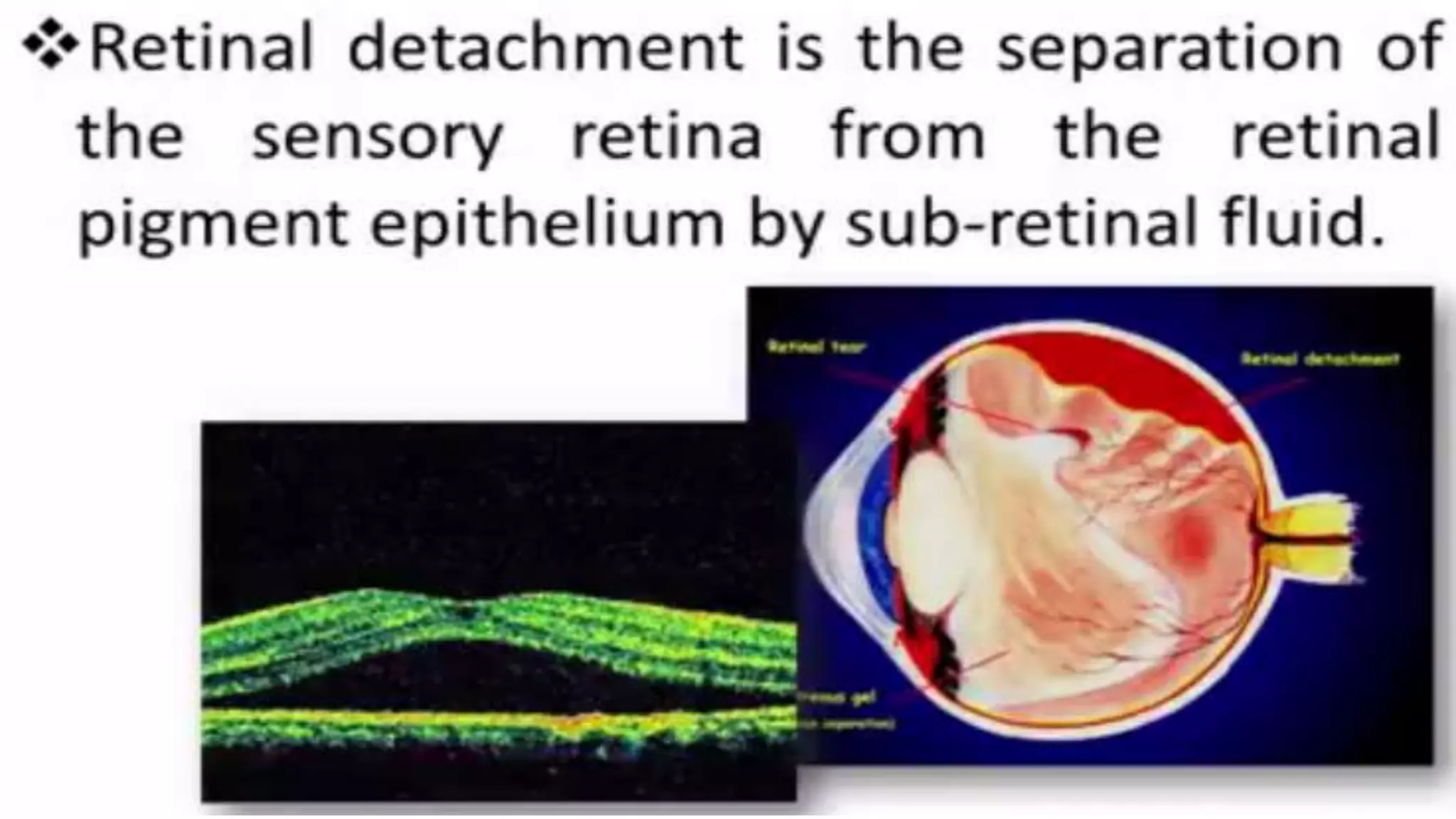 Retina retinal detachment | PPTX