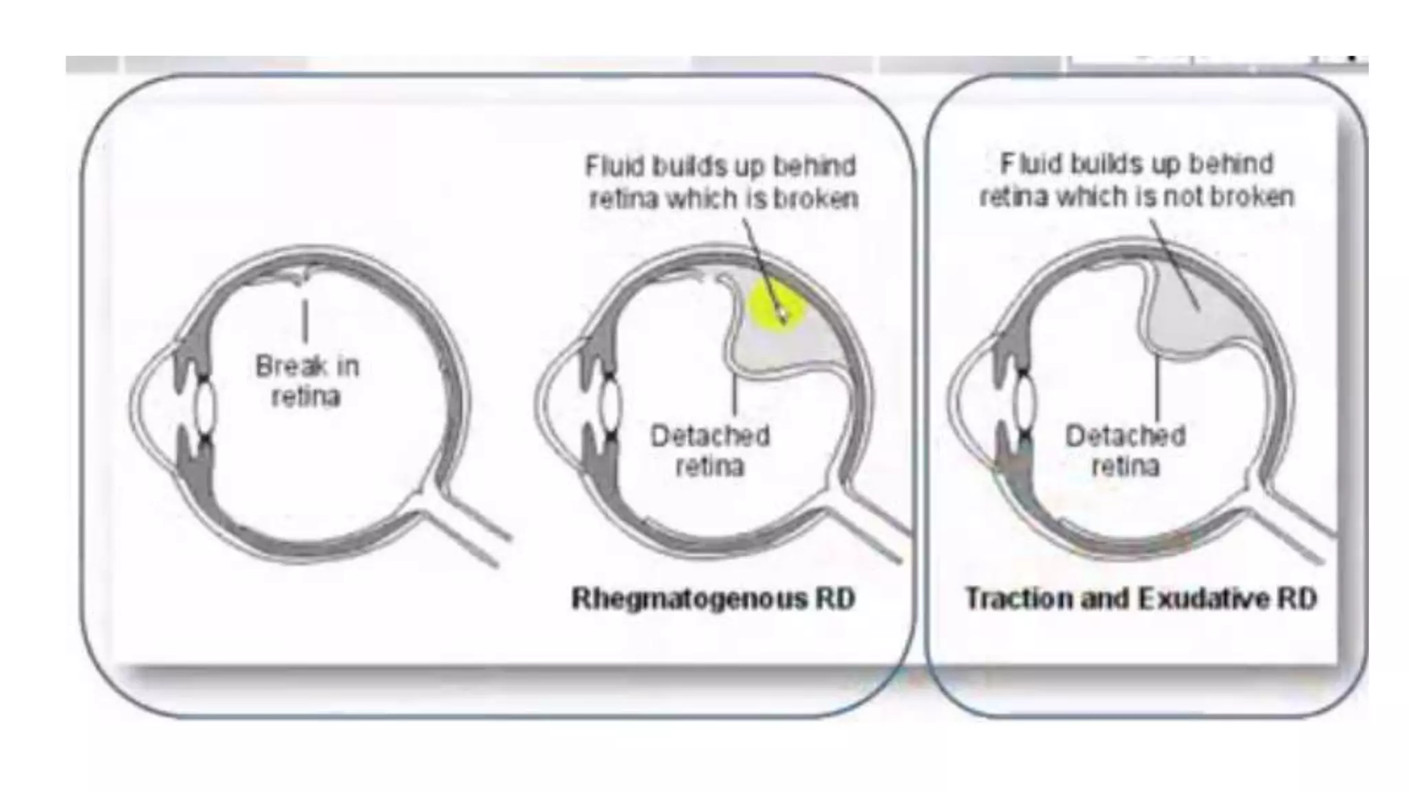 Retina retinal detachment | PPTX | Eye and Vision Conditions | Diseases ...
