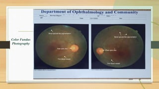 Retinitis Pigmentosa.pptx