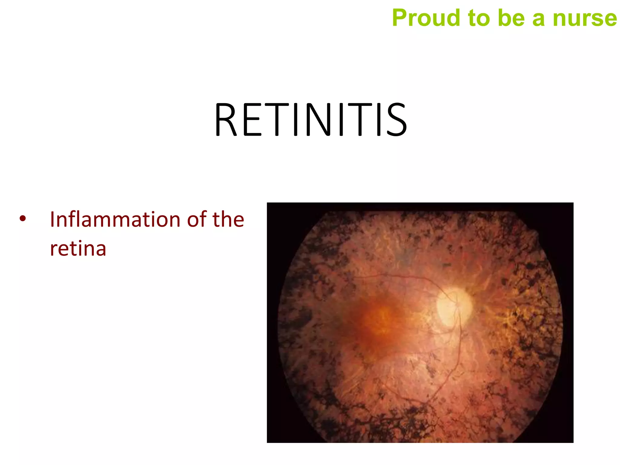 RETINITIS.pptx