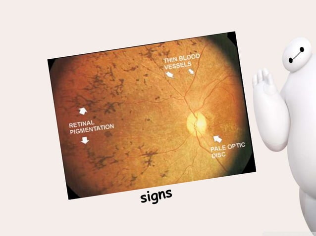 Retinitis pigmentosa | PPT