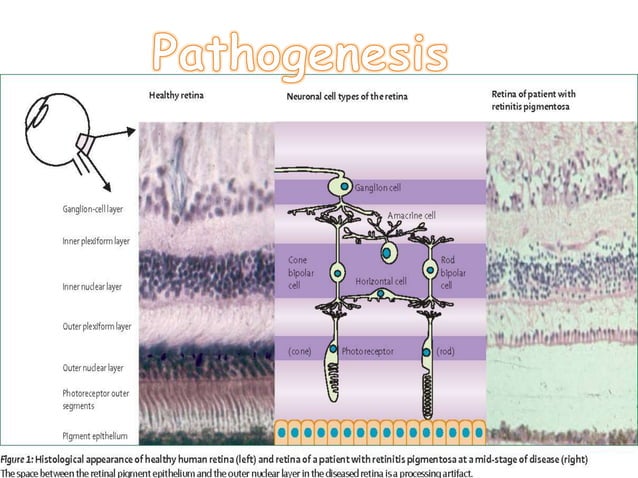 Retinitis pigmentosa | PPT