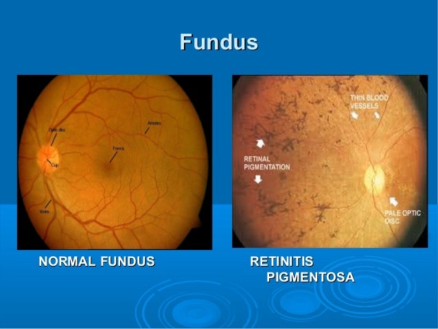 Retinitis pigmentosa