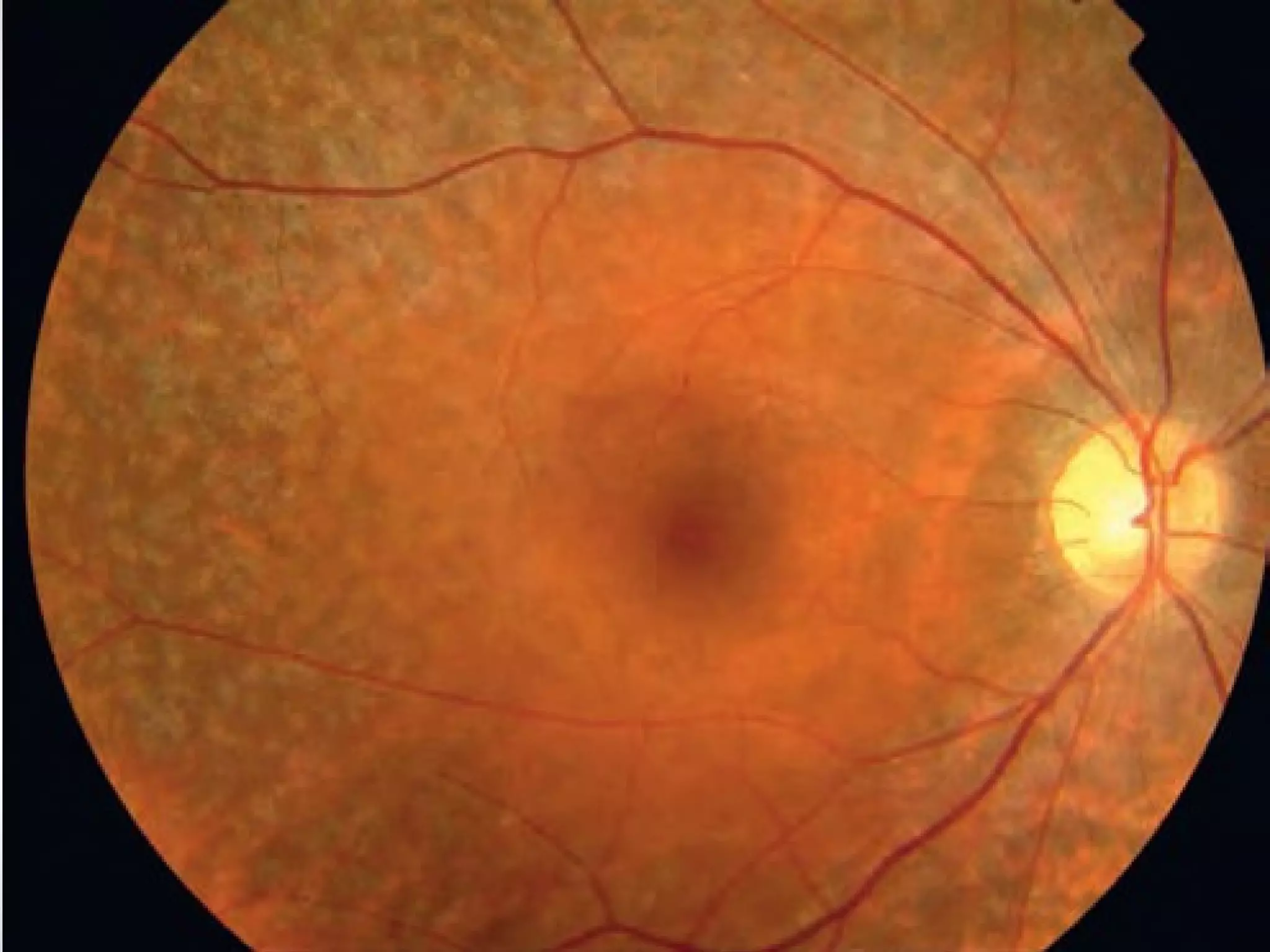 Retinitis pigmentosa | PPT