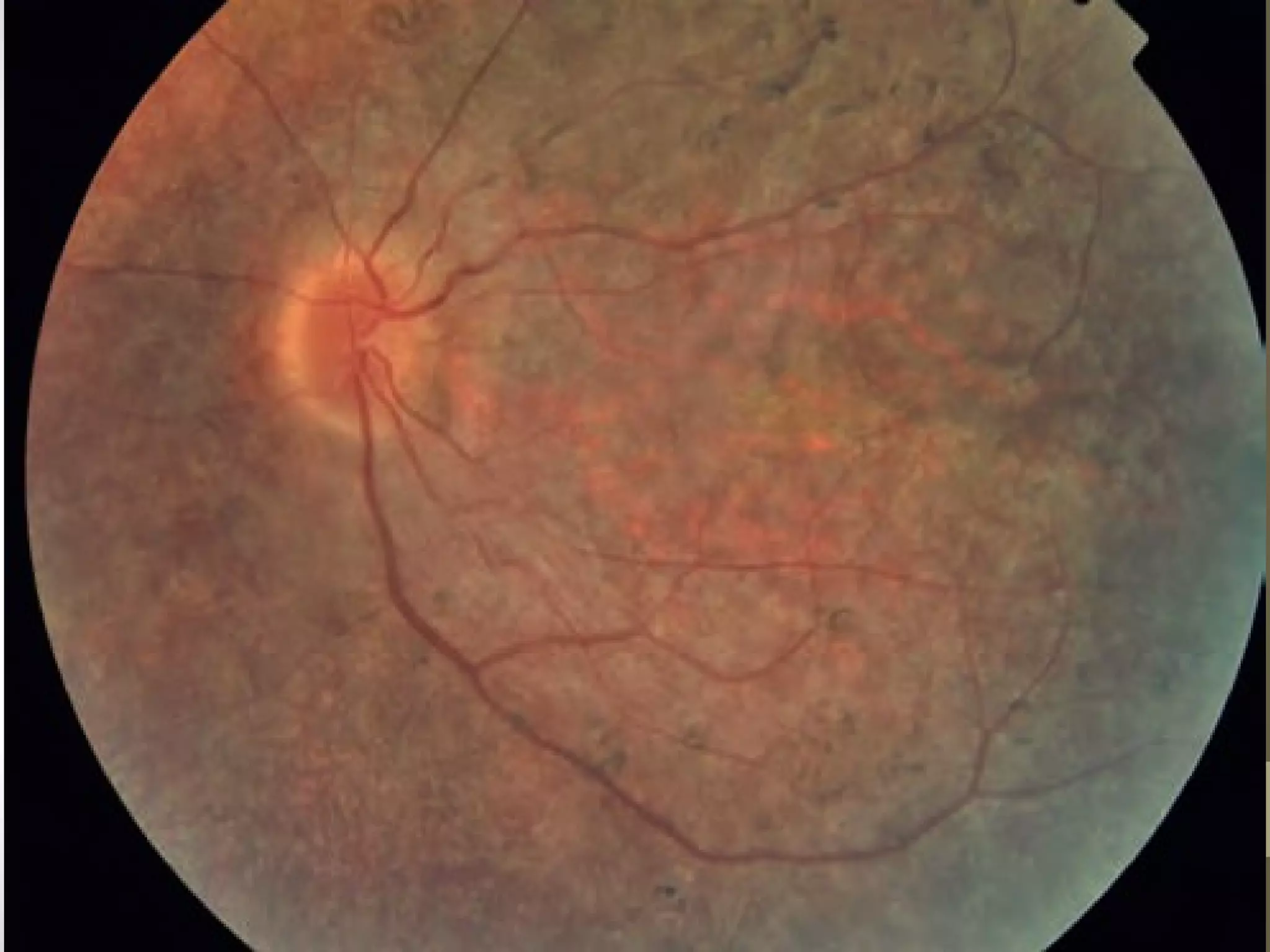 Retinitis pigmentosa | PPT