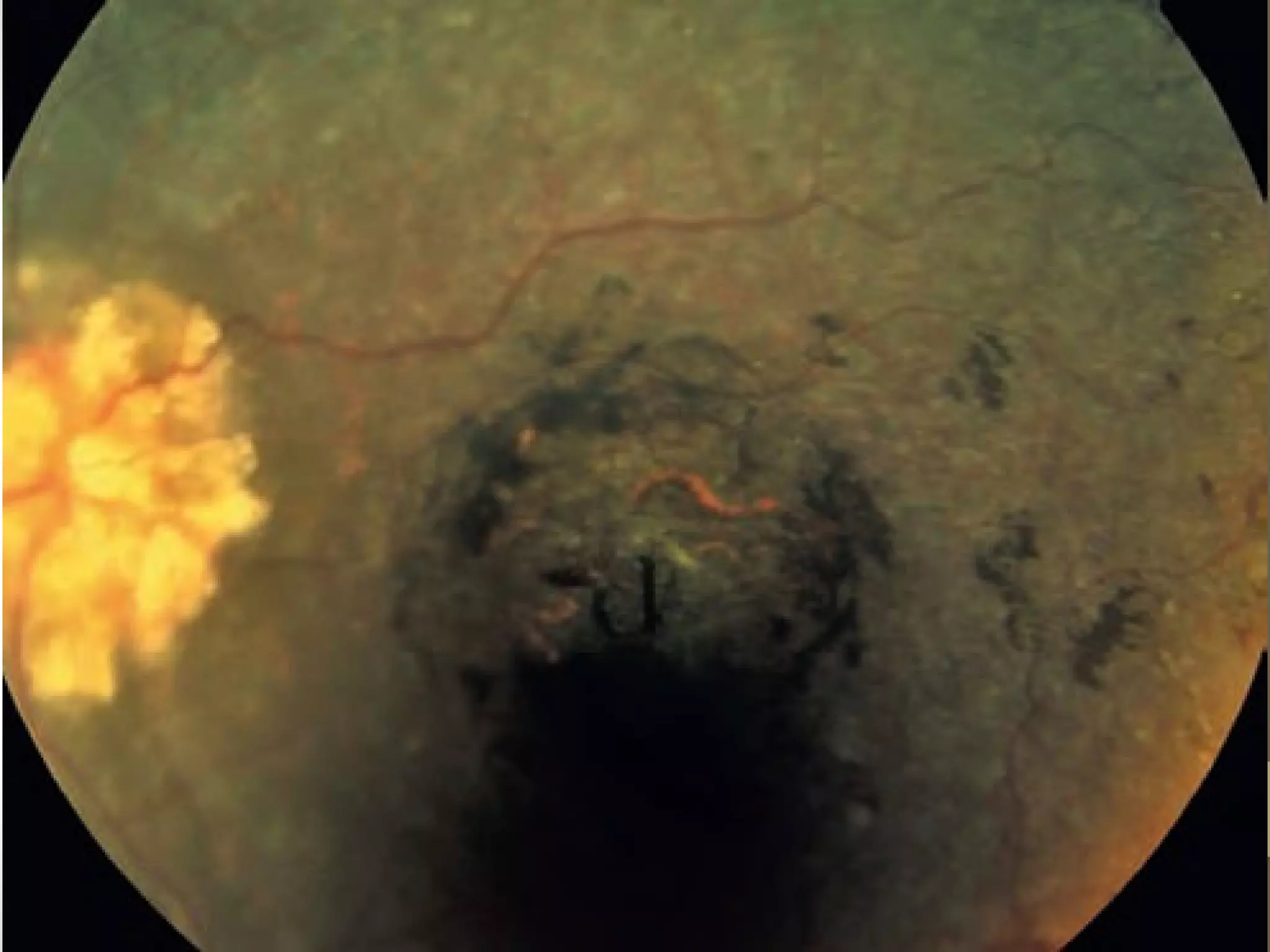 Retinitis pigmentosa | PPT