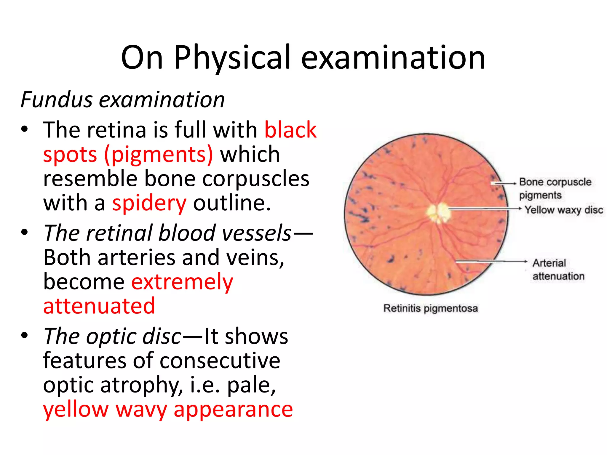 Retinitis pigmentosa (opthalmology) | PPTX