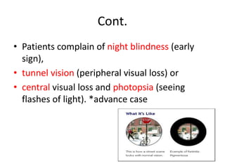 Retinitis pigmentosa (opthalmology) | PPTX | Eye and Vision Conditions ...