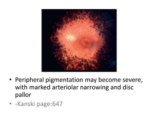 Retinitis pigmentosa (opthalmology) | PPTX | Eye and Vision Conditions ...