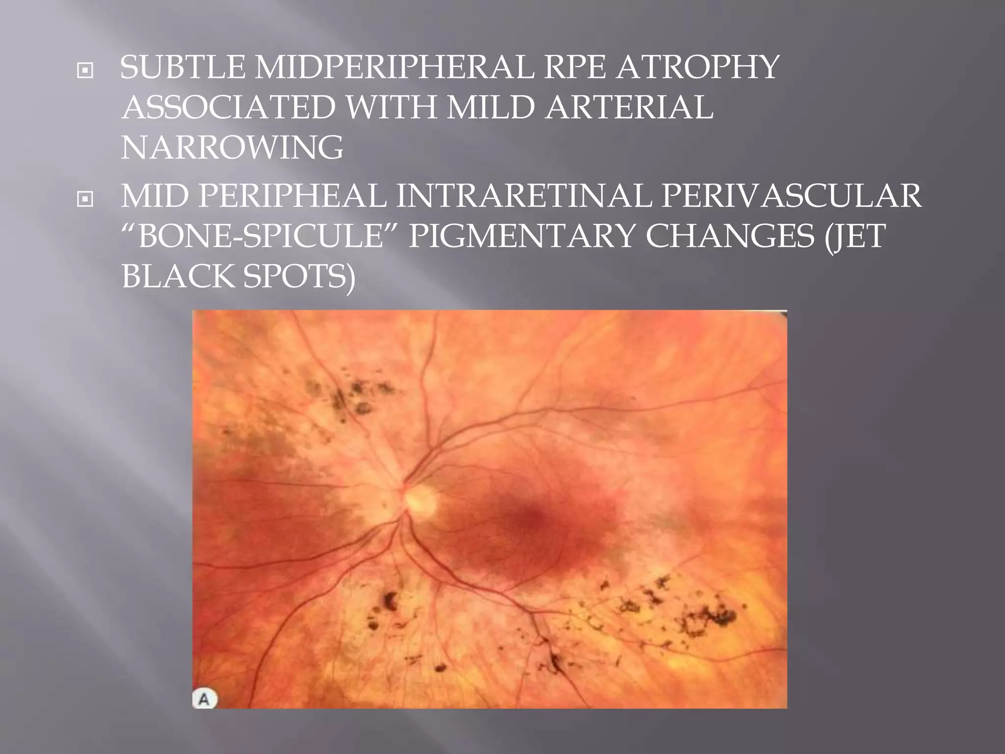 Retinitis pigmentosa | PPTX