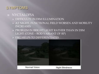 Retinitis pigmentosa | PPTX