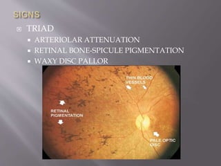Retinitis pigmentosa | PPT