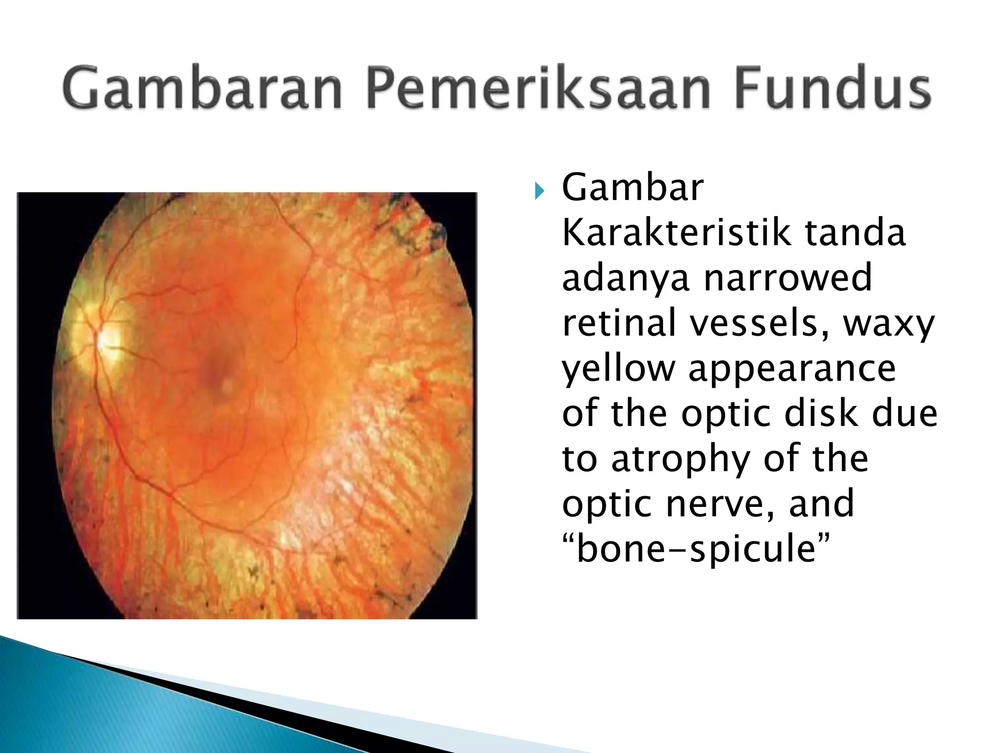 Retinitis pigmentosa | PPTX