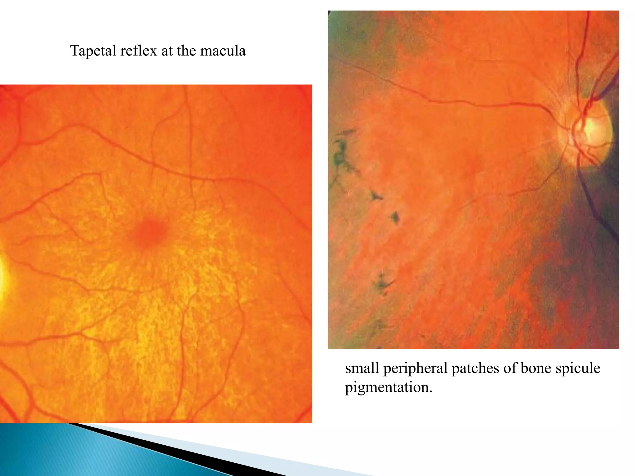 Retinitis pigmentosa | PPTX