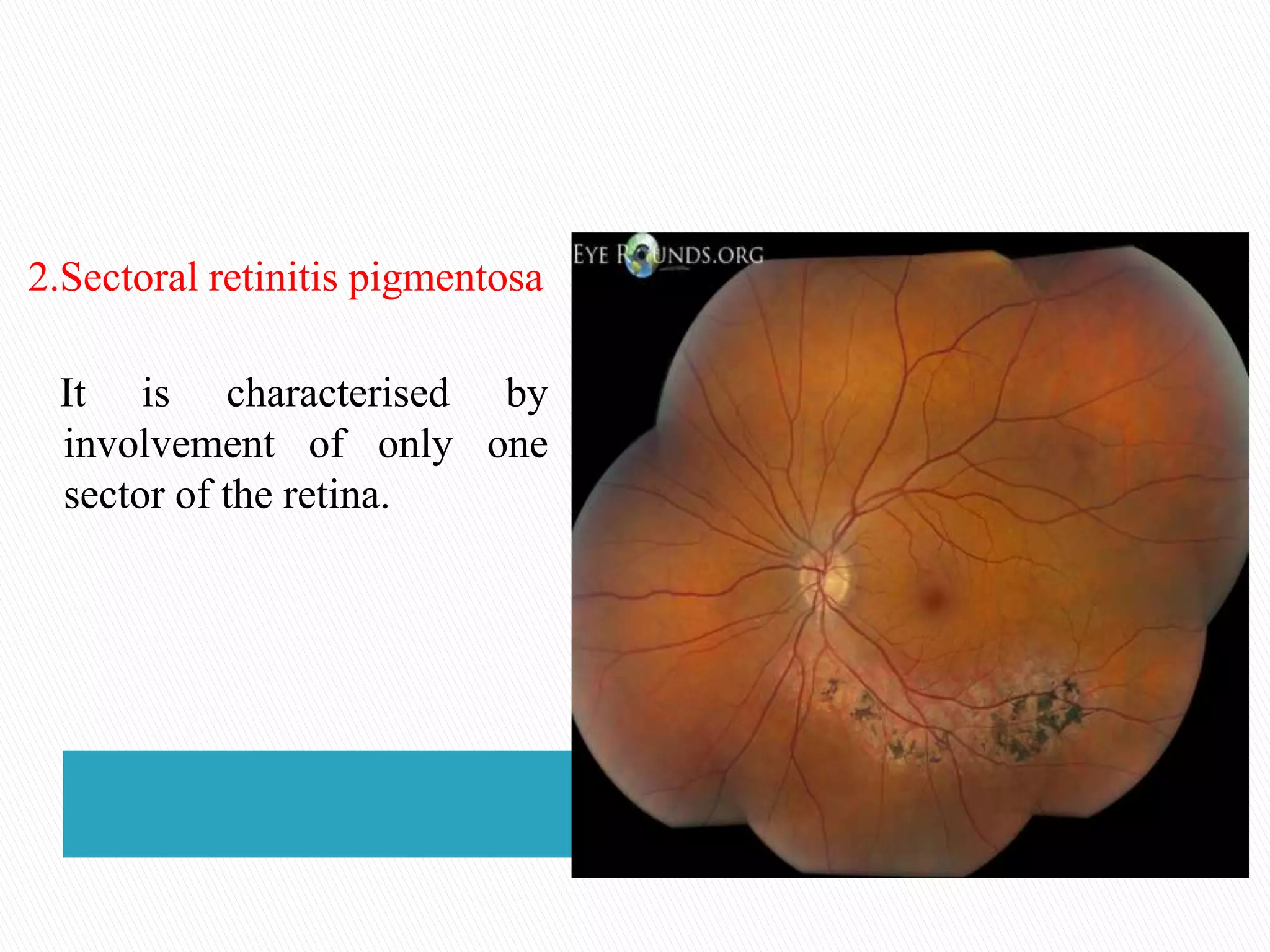 Retinitis pigmentosa | PPTX