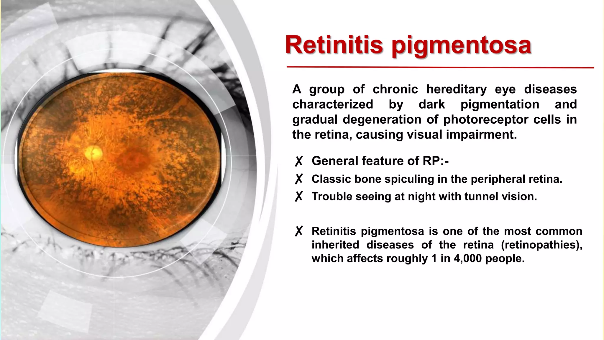 Retinitis pigmentosa | PPTX