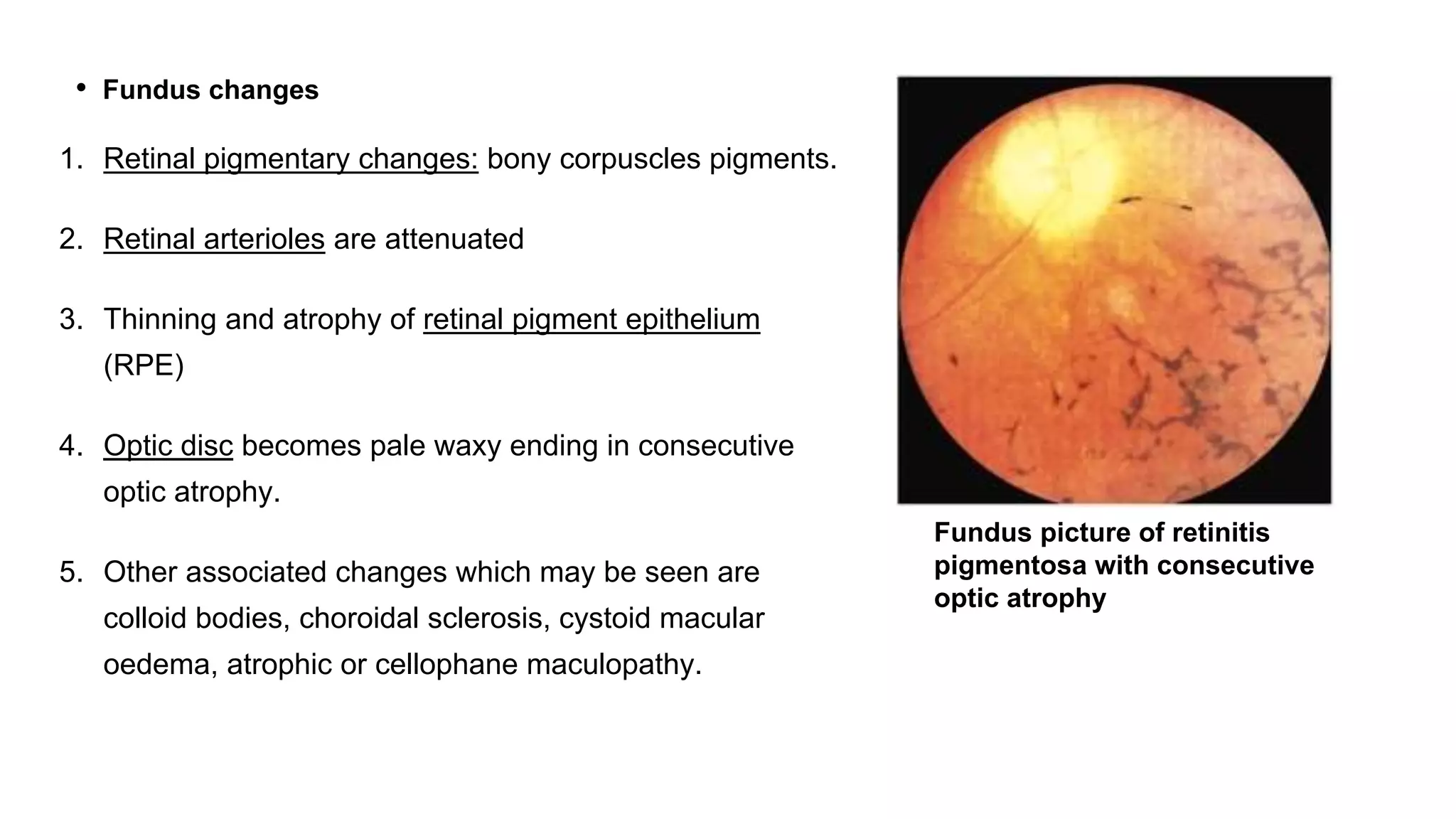 Retinitis Pigmentosa | PPTX | Eye and Vision Conditions | Diseases and ...