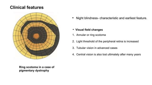 Retinitis Pigmentosa | PPT