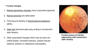 Retinitis Pigmentosa | PPTX | Eye and Vision Conditions | Diseases and ...