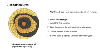 Retinitis Pigmentosa | PPT