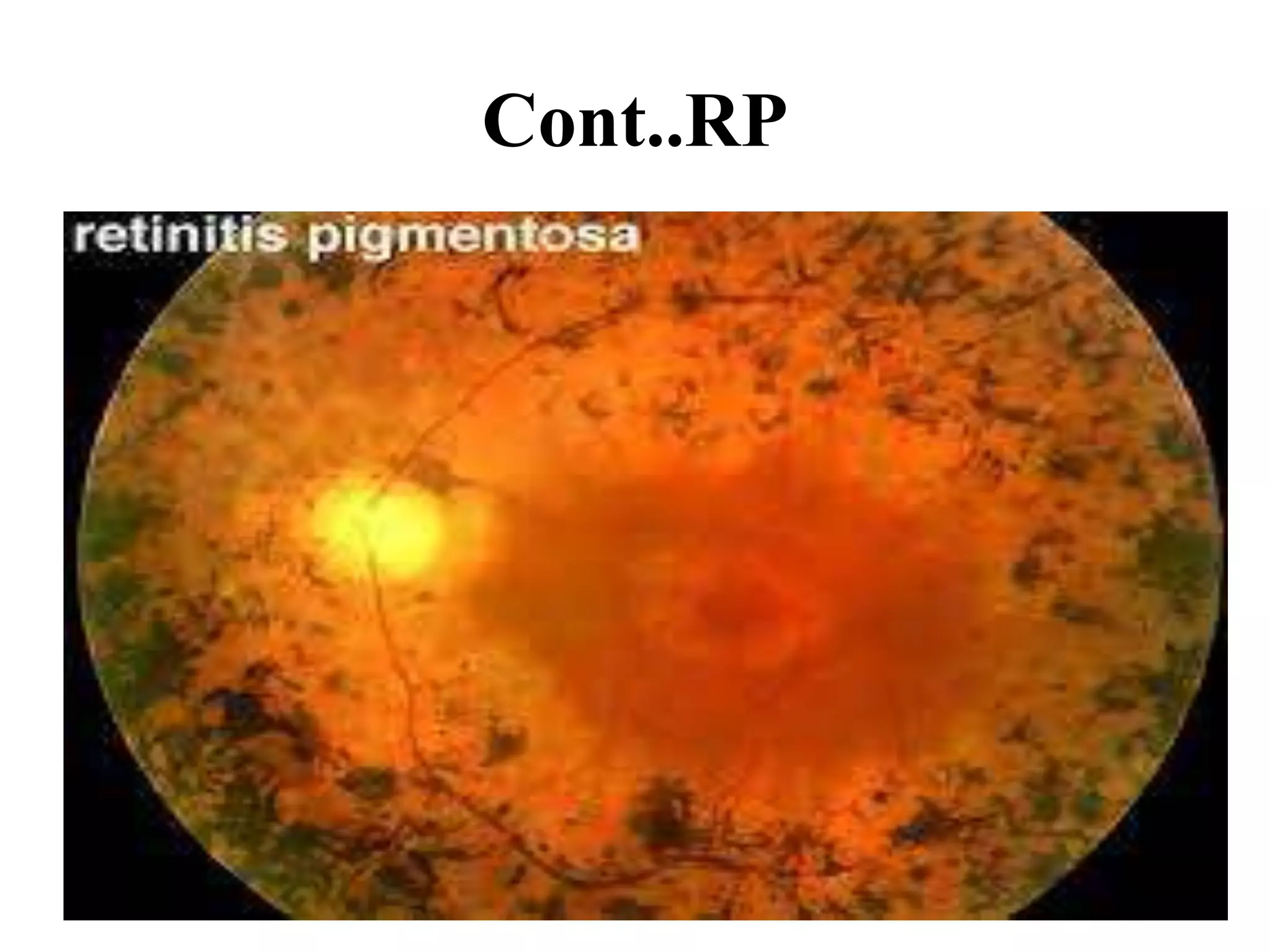 RETINITIS PIGMENTOSA.pptx
