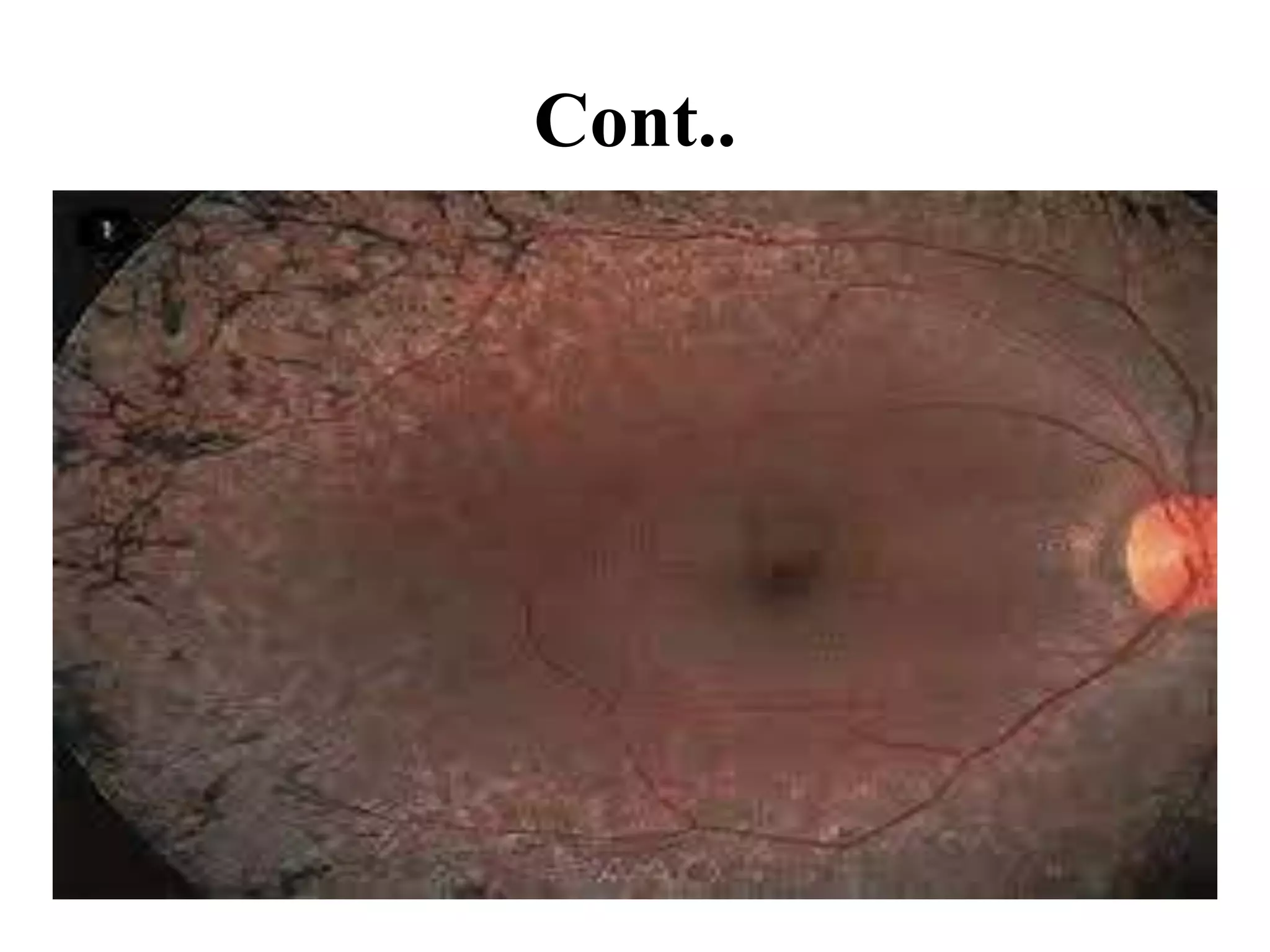 RETINITIS PIGMENTOSA.pptx